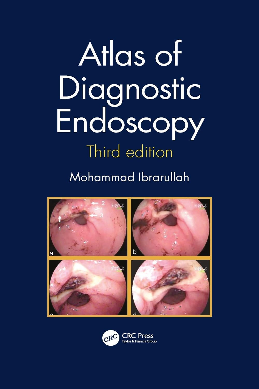 Atlas of Diagnostic Endoscopy, 3E by Mohammad Ibrarullah, Paperback ...