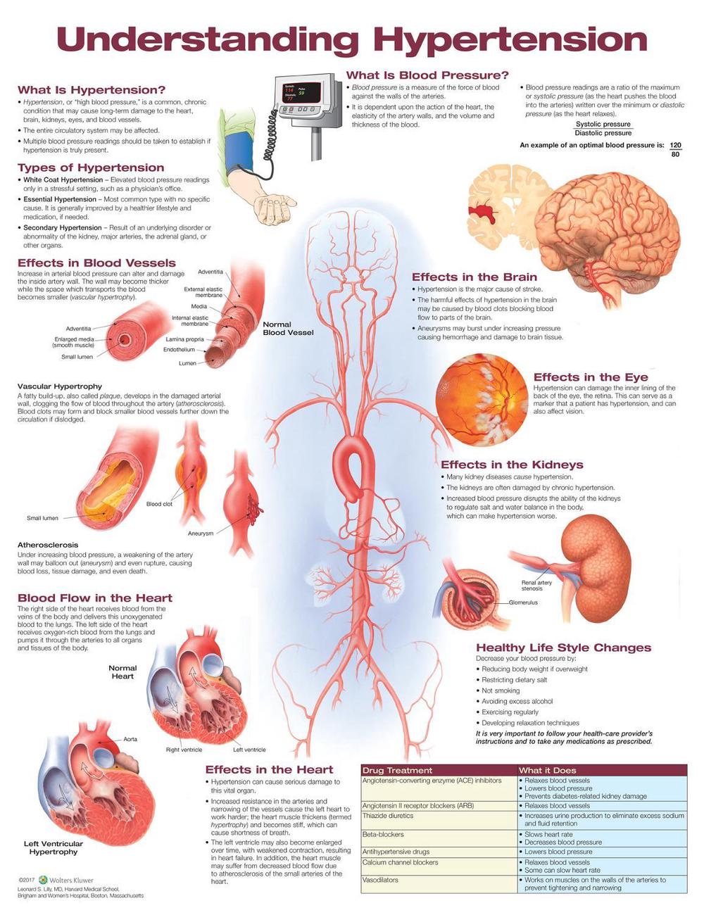Understanding Hypertension By Anatomical Chart Company 9781496369819