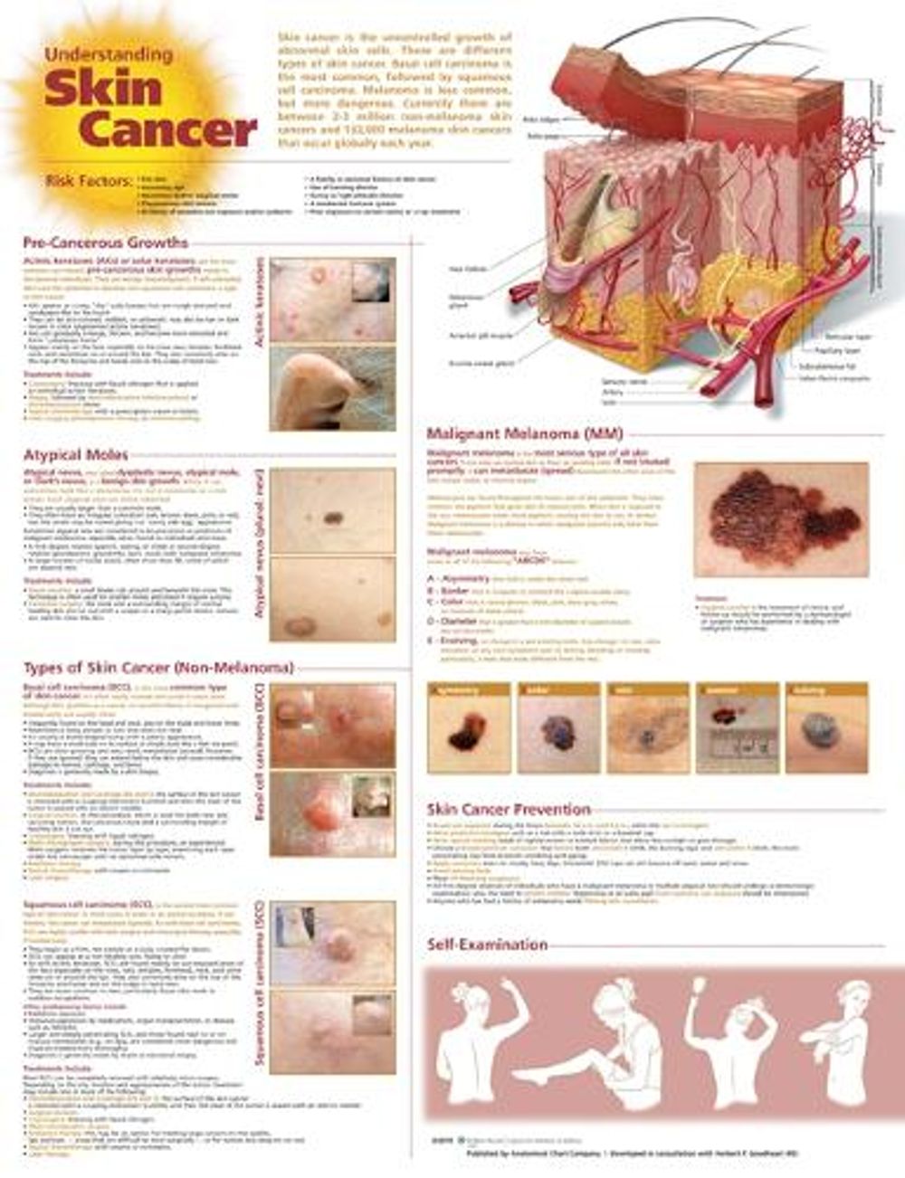 Understanding Skin Cancer Anatomical Chart by Anatomical Chart Com ...