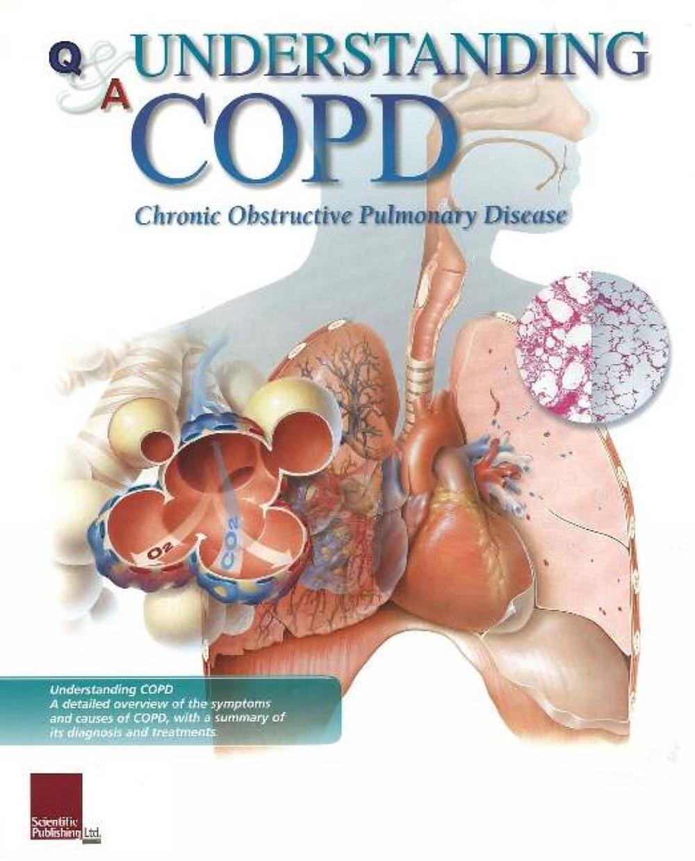Understanding COPD Flip Chart by Scientific Publishing, Spiral, 9781932922295 | Buy online at ...
