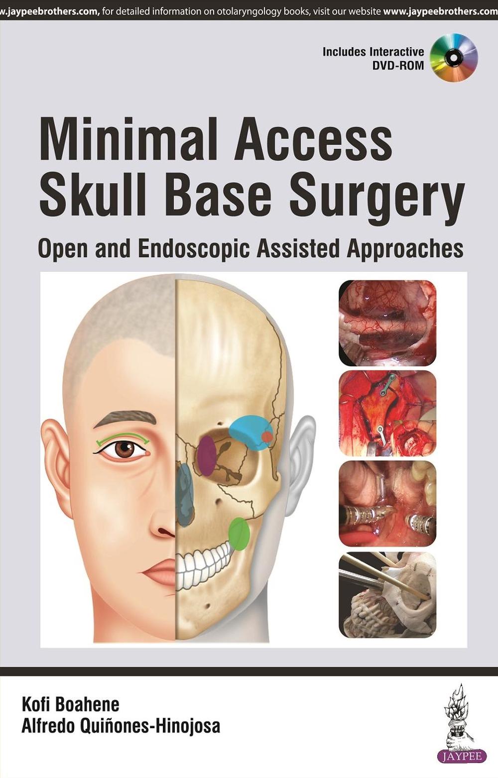 Minimal Access Skull Base Surgery by Kofi Derek O. Boahene, Hardcover ... Minimal Access Skull Base Surgery by Kofi Derek O. Boahene, Hardcover ...